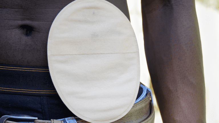 Stoma reversal - Rhodes Pharma