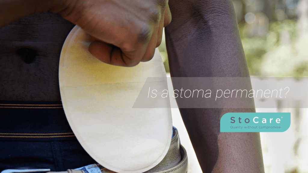 Is a stoma permanent? - StoCare - Rhodes Health