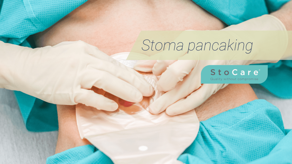 Stoma pancaking - Rhodes Pharma