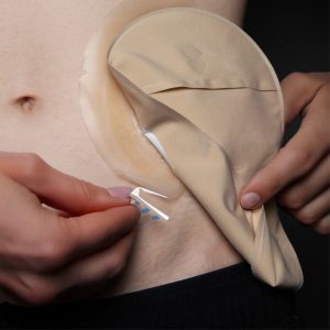 StoCare Extend Hydrocolloid Flange Extender