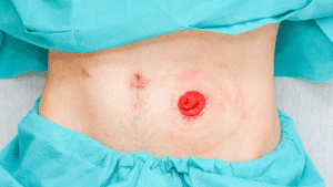 Stoma granuloma - StoCare - Rhodes Health